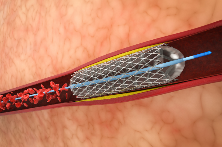 Coronary Angioplasty and Stenting - Pulse Hospital